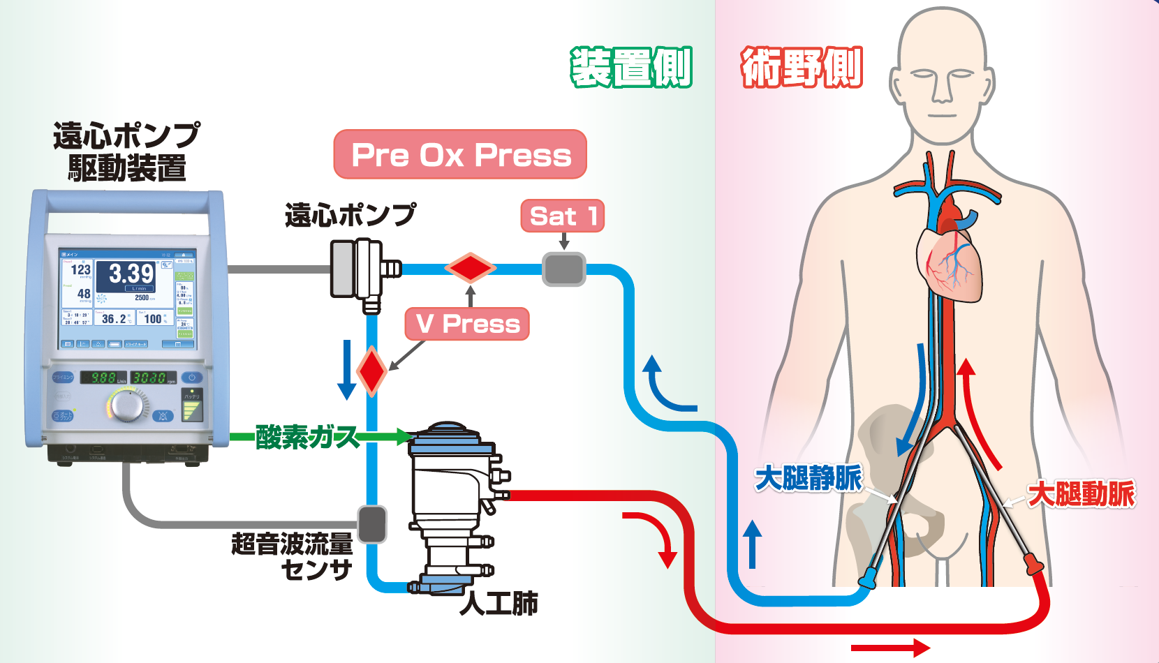 ECMO（エクモ）とは何か？ - MERA 泉工医科工業株式会社 ―医療と共に歩む、信頼のメラ製品―