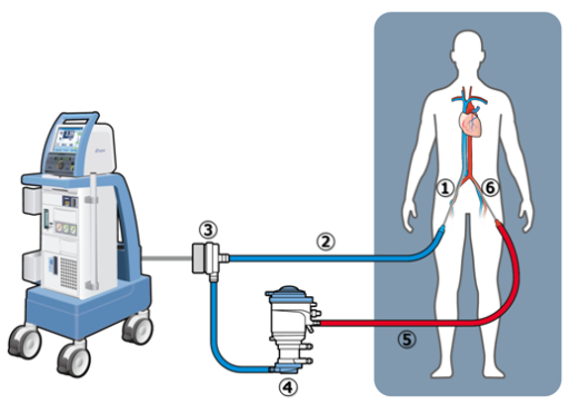 ECMO（エクモ）回路とシステムの構成について - MERA 泉工医科工業株式会社 ―医療と共に歩む、信頼のメラ製品―