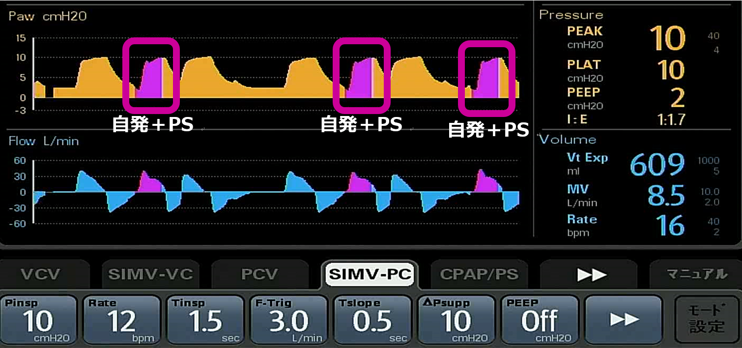 実は便利⁉ SIMVモードについて - MERA 泉工医科工業株式会社 ―医療と共に歩む、信頼のメラ製品―