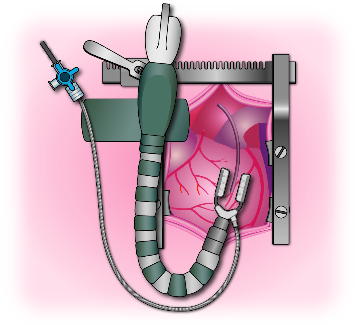 冠状動脈の検査と治療 - MERA 泉工医科工業株式会社 ―医療と共に歩む、信頼のメラ製品―